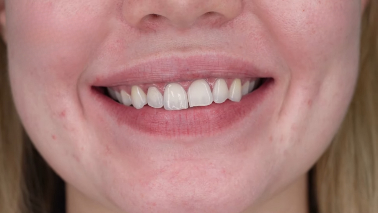 How Long Does Purple Teeth Whitening Last? - Water Town Dental Health