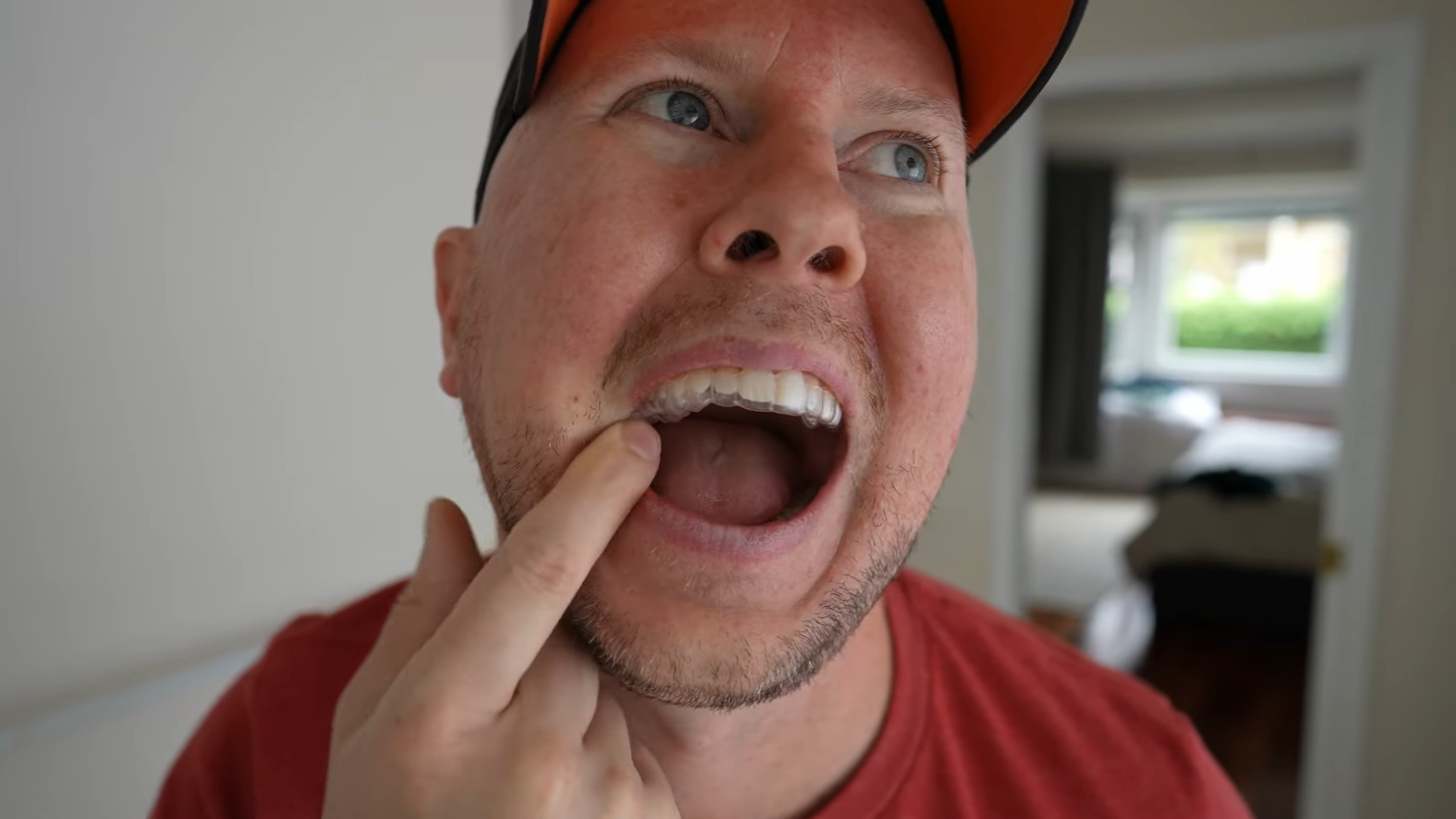 Invisalign vs. Braces - Which Is More Effective for Complex Cases ...