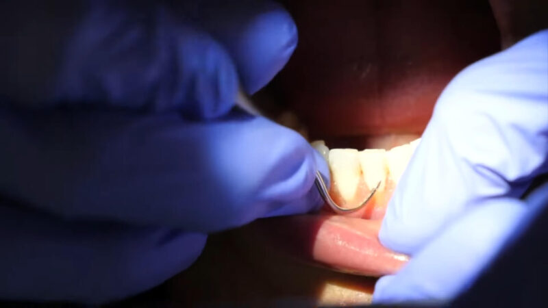Scaling and Root Planing - What to Expect During a Deep Teeth Cleaning - Water Town Dental Health